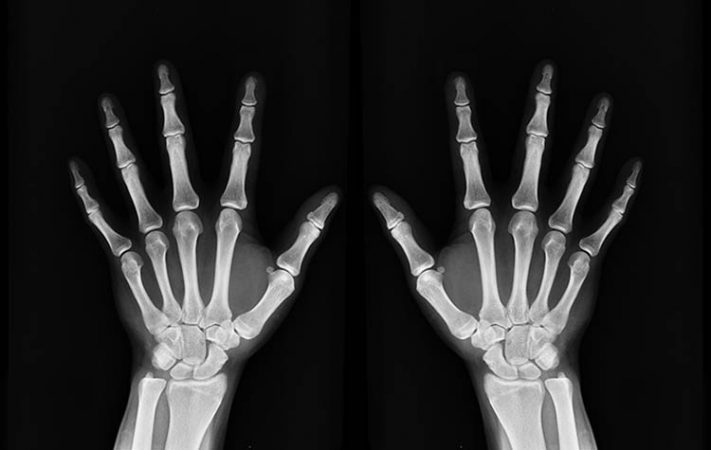 Signs and Symptoms of Vitamin D Deficiency You Should Know